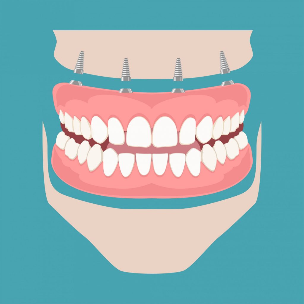 Benefits of Replacing a Full Arch of Teeth with Dental Implants