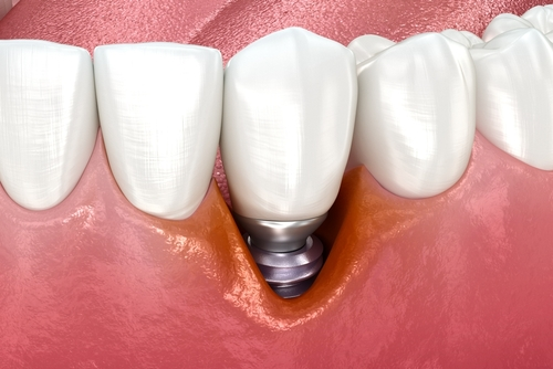 LAPIP: The Future of Treating Peri-Implantitis and Saving Your Dental ...
